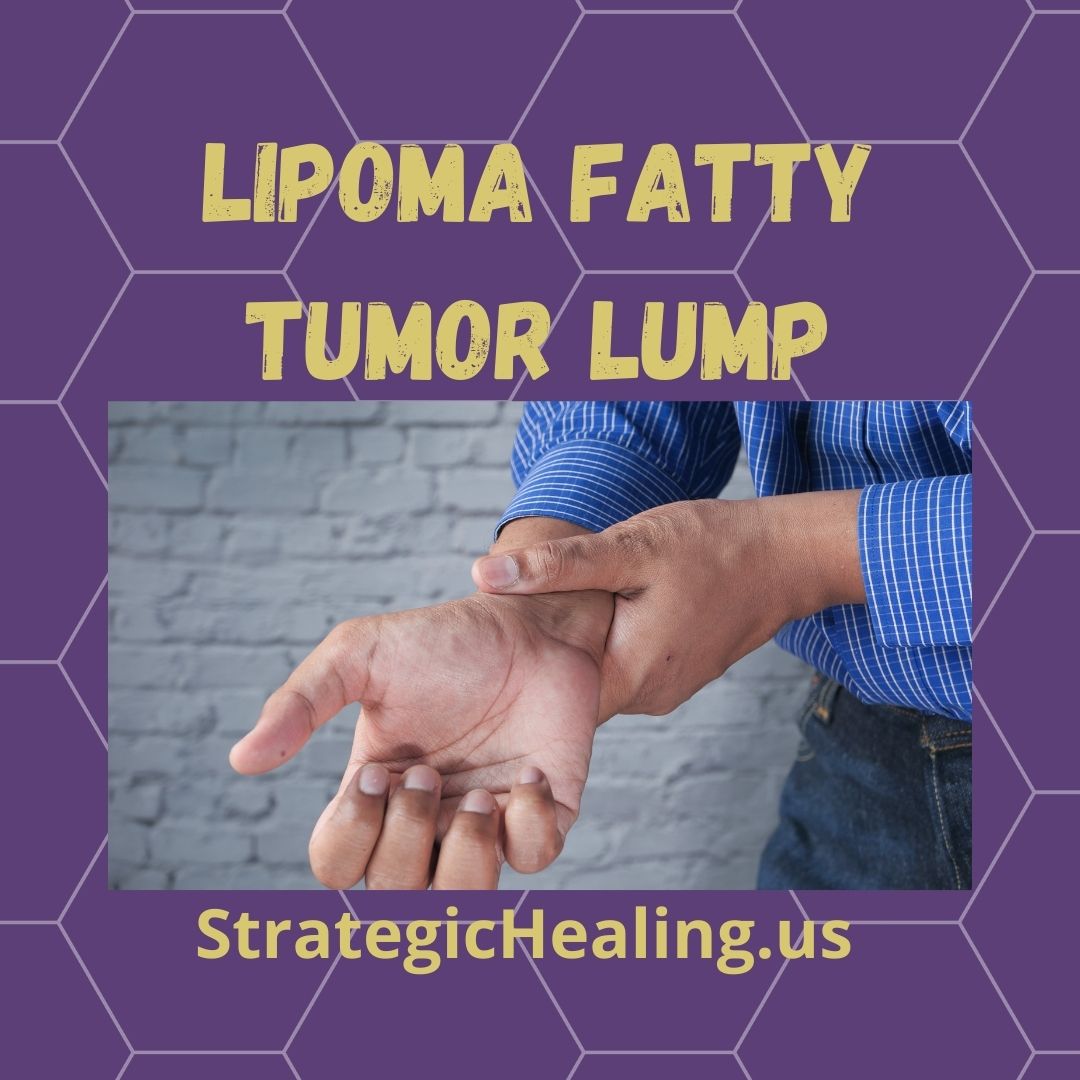 Lipoma: Fatty Tumor Lump: HealingMatters 96 › Strategic Healing